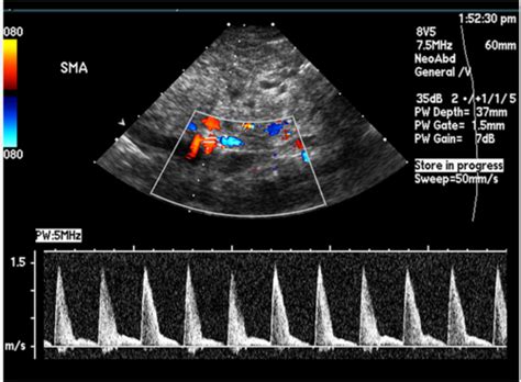 Abdominal Doppler Flashcards Quizlet