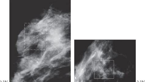 The Evolution Of Casting Type Calcifications Oncohema Key