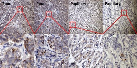 Immunohistochemical Staining For Cd133 In Clinical Cd133 Expression