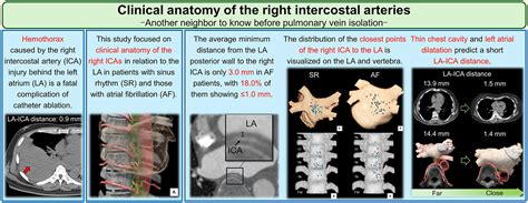 Clinical Anatomy Of The Right Intercostal Arteries Another Neighbor To