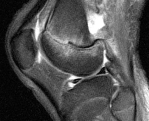 Salter Harris Fractures Radsource