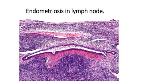 Benign Inclusions In Lymph Nodes Histopathology Ppt
