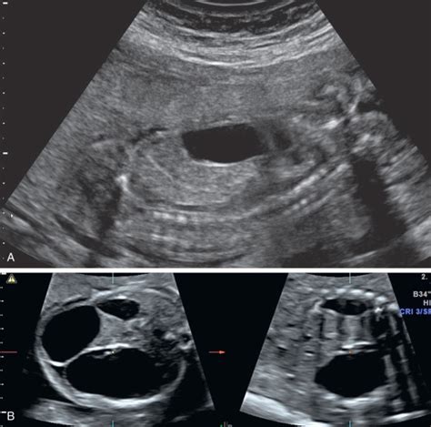 Hepatic Anomalies Radiology Key