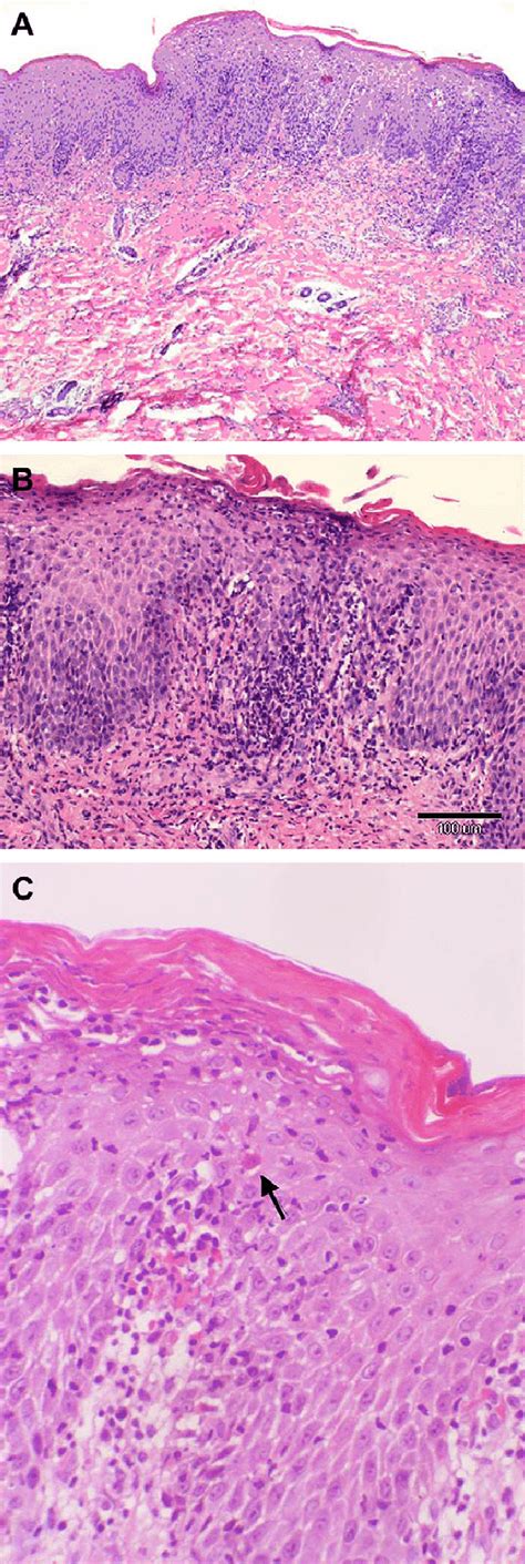 Aec The Epidermis Shows Spongiotic Psoriasiform Spongiotic Download Scientific Diagram