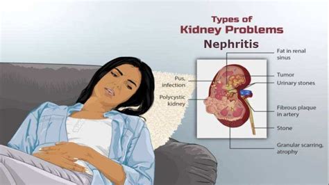 Nephritis Symptoms Causes Types And Treatment By Healthlinz