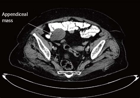 Figure 1 From Laparoscopic Appendectomy For Appendiceal Mucocele In An