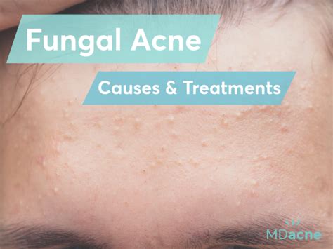 Simple Skincare Science Fungal Acne Trains Times