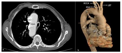 Ct Angiography For Aortic Arch Anomalies Prevalence Diagnostic