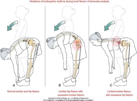 Lower Extremity Hip Flashcards Quizlet
