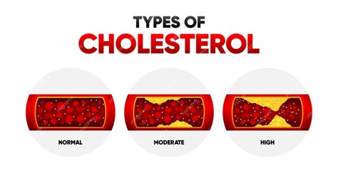Premium Vector Types Cholesterol Ldl And Hdl Level Arteriosclerosis