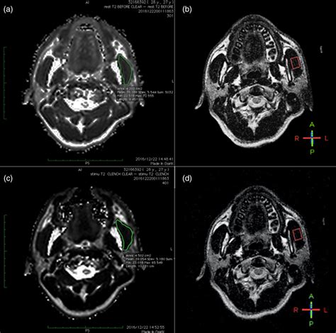 A C Representative Axial Plane T2‐weighted Mr Images Obtained At The Download Scientific
