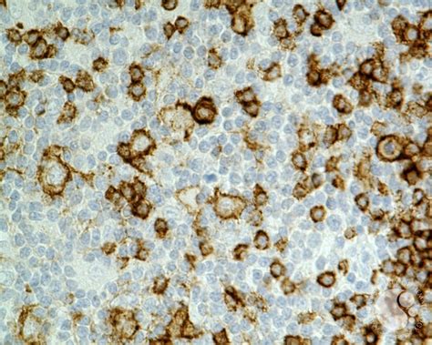 Nlphl With Progression