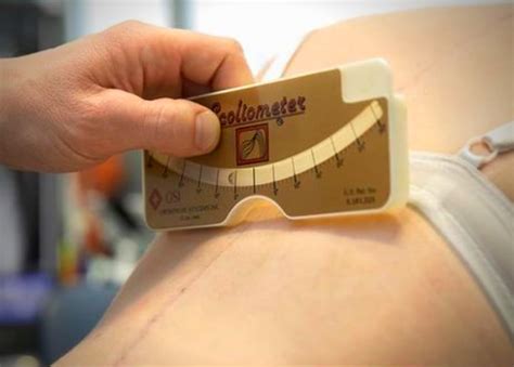 Understanding Bracing Effectiveness When Treating Adolescent Idiopathic
