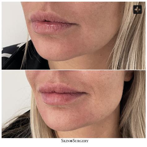 Voor En Na Foto S SkinSurgery Clinics
