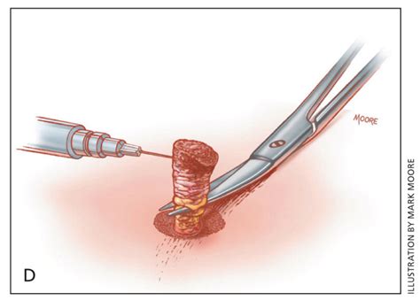 Nerve Testing Ipsum Diagnostics