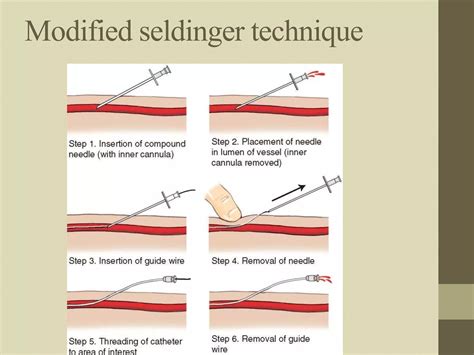 Peripheral Angiography Pptx