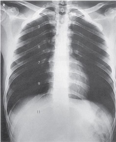 Rib Ap View Diagram Quizlet