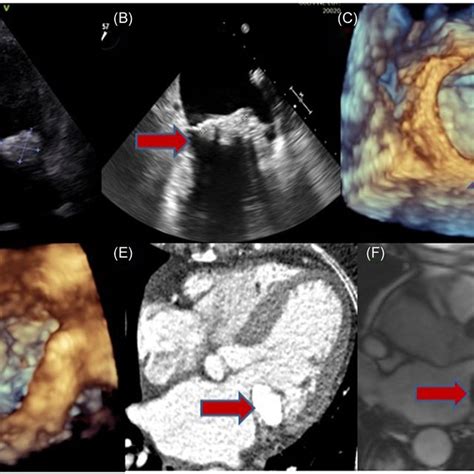 Multimodality Imaging Of The Caseous Calcification Of The Mitral