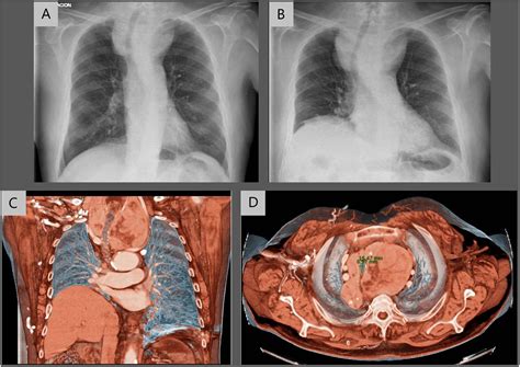 Unilateral Phrenic Nerve Palsy In A Patient With A Giant Intrathoracic