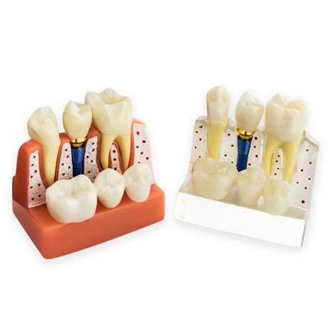 Dental Model 4 Times Dental Implant Analysis Crown Bridge Demonstration