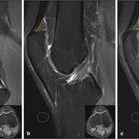 Mri 3 T Sagittal Pd Tse Fat Suppressed Slices Spfp Relative Signal