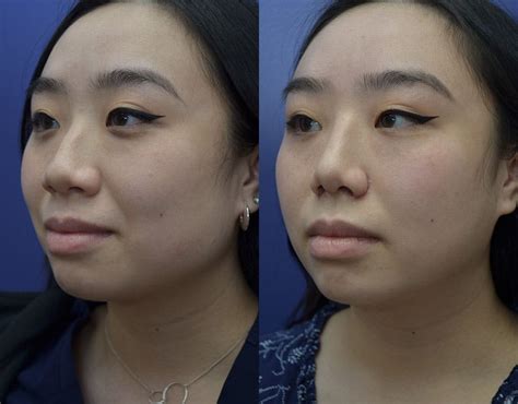 Patient 123887643 Alarplasty Before And After Photos Tansavatdi