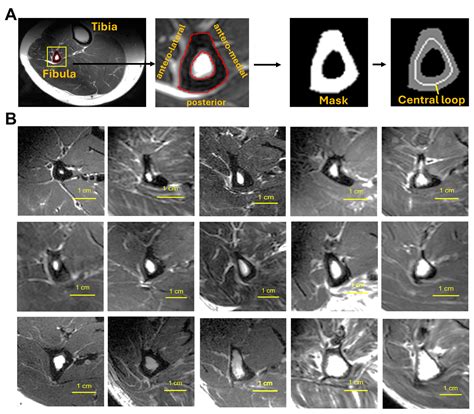A 7t Mri Study Of Fibular Bone Thickness And Density Impact Of Age
