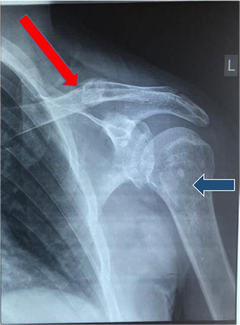 Left Shoulder Ray Hot Sex Picture