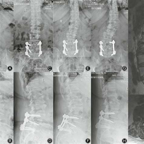 A 55 Year Old Male Underwent L4 5 Fusion Because Of Spinal Stenosis 3