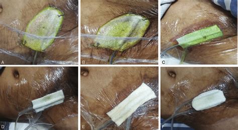 A The Condition Of The St VSD At St Day Postoperatively B F The Download Scientific