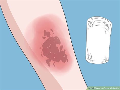 Easy Ways To Cover Cellulitis 8 Steps With Pictures Wikihow Health