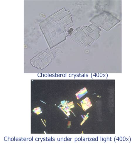 Cholesterol Crystals In Urine Polarized