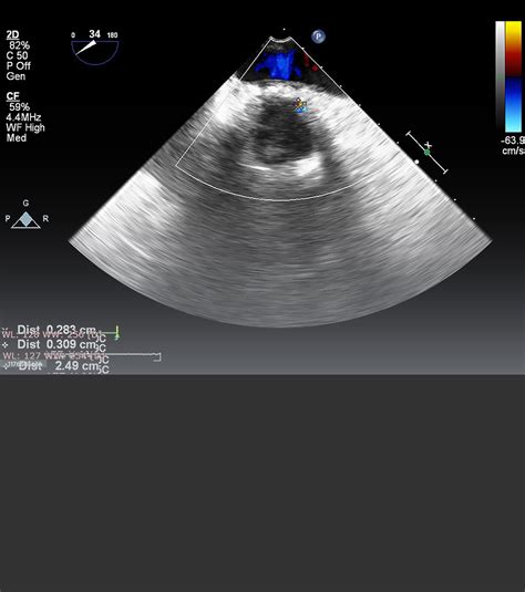 Endometrial Cancer Treatment Center Thangam Cancer Center