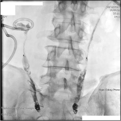Final Nephrostogram Demonstrating No Contrast Leakage Beyond