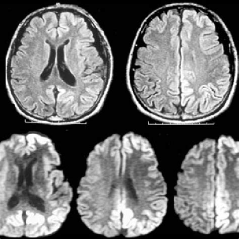 Brain Mri Study Showing Gyriform Hyperintensity On Flair A And