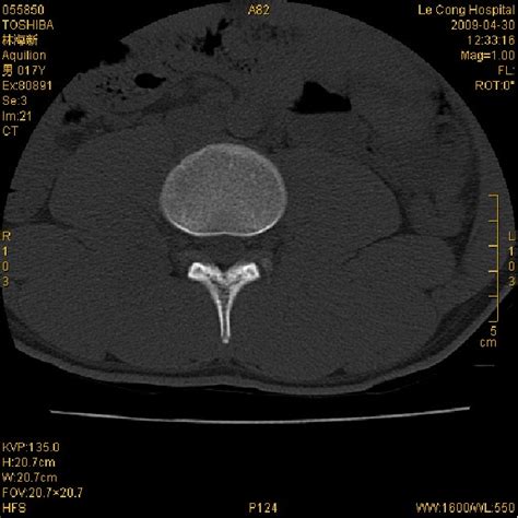 胸腰椎爆裂性骨折的影像学诊断！ 德医医学 助力医学教育发展！
