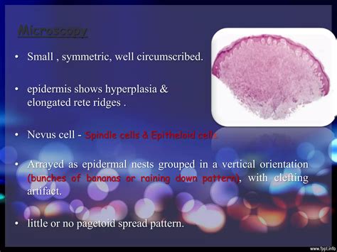 Melanocytic Lesion Of Skin Final Pptx