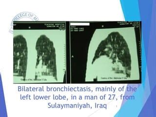 Bronchiectasis Of The Left Lower Lobepdf