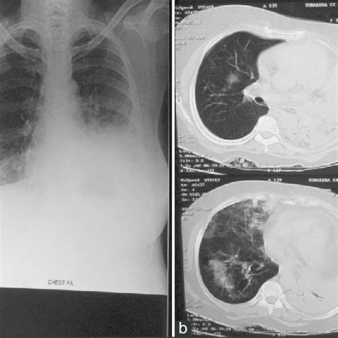 Chest X Ray A Showing Bilateral Lower Zone Heterogeneous Opacity