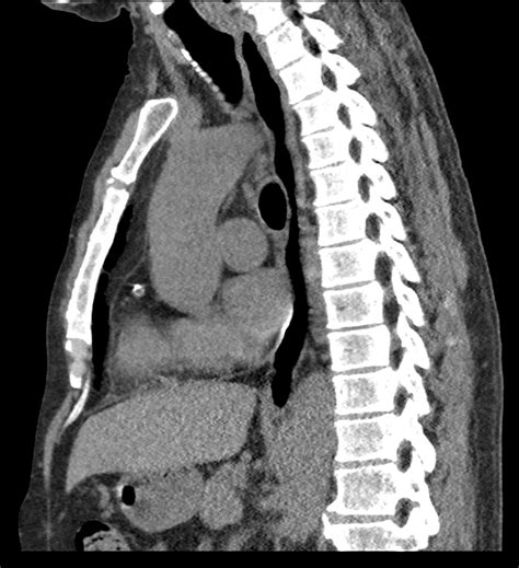 000 Nonspecific Interstitial Pneumonia Nsip Lungs