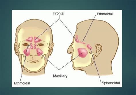 3b Paranasal Sinuses Diseases Flashcards Quizlet