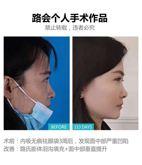 做内吸去眼袋失败后，方才明白的6件事 京东健康
