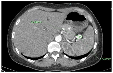 Splenic Artery Aneurysm Ultrasound