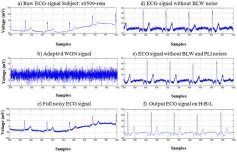 Steps Of De Noising Ecg Signal Using The H B L Configuration Download Scientific Diagram