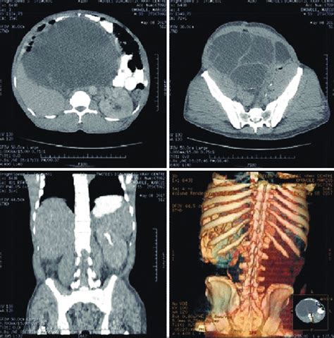 Computerized Tomogram Of The Abdomen Showing A Normally Sited Left