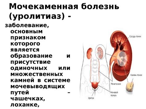 Мочекаменная болезнь Схемы Биохимия Docsity