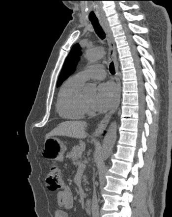Xiphoid Shape Variations Radiology Reference Article Radiopaedia Org