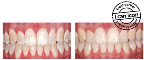 ICON Korekta przebarwień zatrzymanie próchnicy Poznań Smile Studio