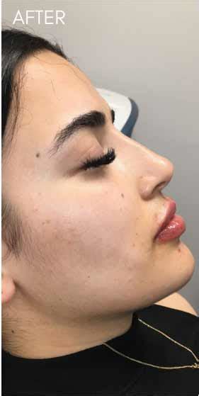 Patient 11345 Chin Filler Before And After Photos Brea Med Spa