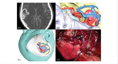 Segmentation Of AVM Of Right Temporal Bone On CT AG Soft Tissues